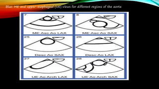 TEE VIEWS transesophageal echocardiography views.pptx