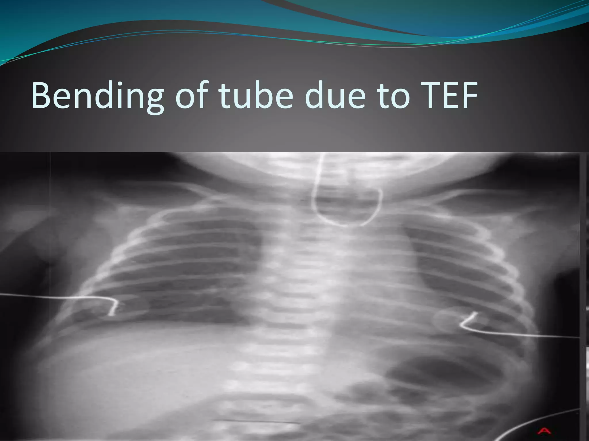 Tracheo-Esophageal Fistula (In Pediatrics) | PPTX