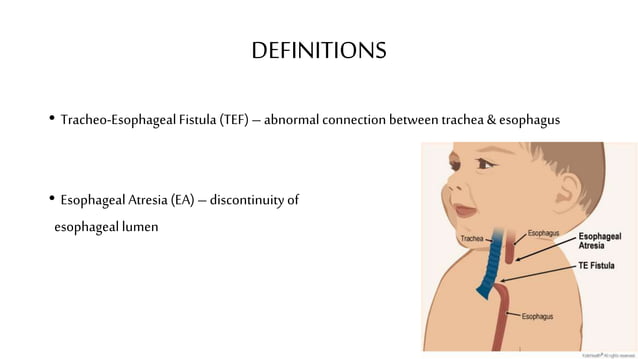 Anesthetic Considerations in Tracheo-esophageal Fistula | PPTX | Lung ...