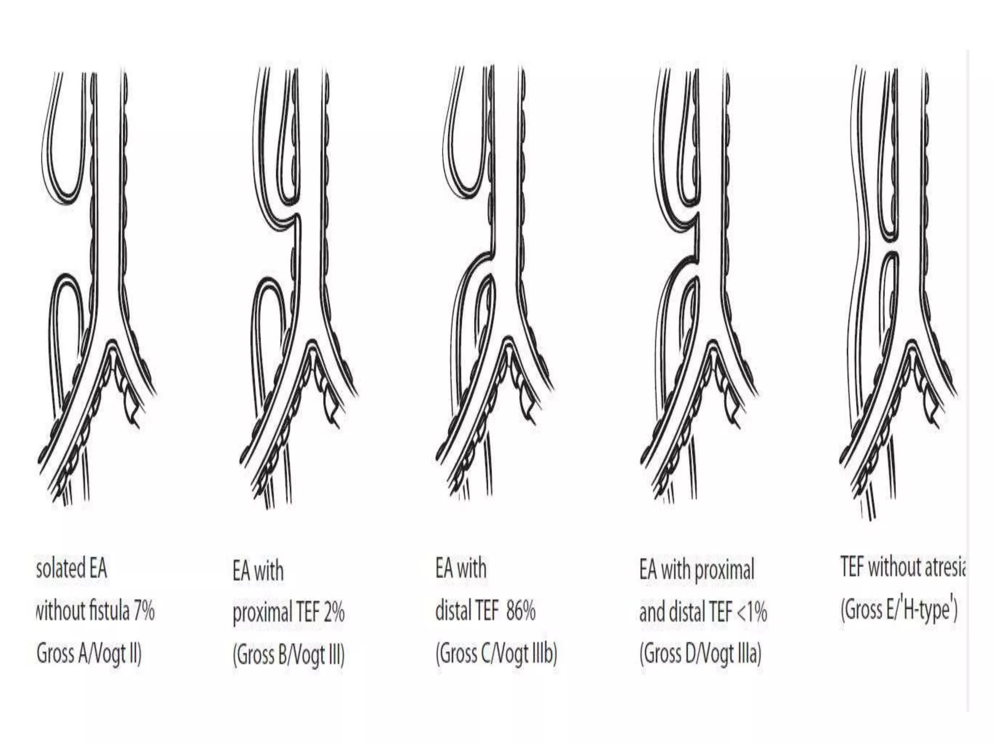 Tracheo-esophageal fistula and its anaesthetic consideration | PPTX