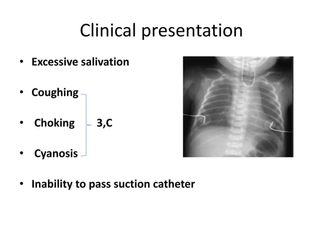 Tracheo-esophageal fistula and its anaesthetic consideration | PPTX