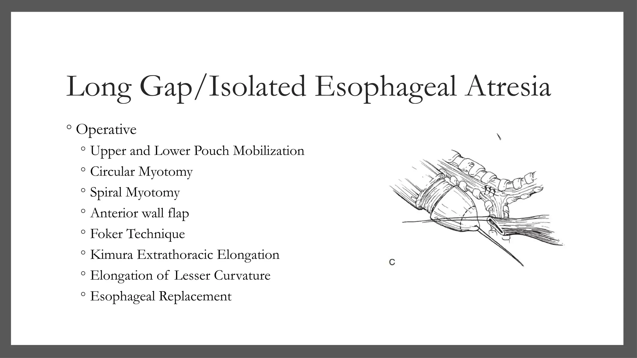Esophageal Atresia with Tracheo-esophageal Fistula | PPTX