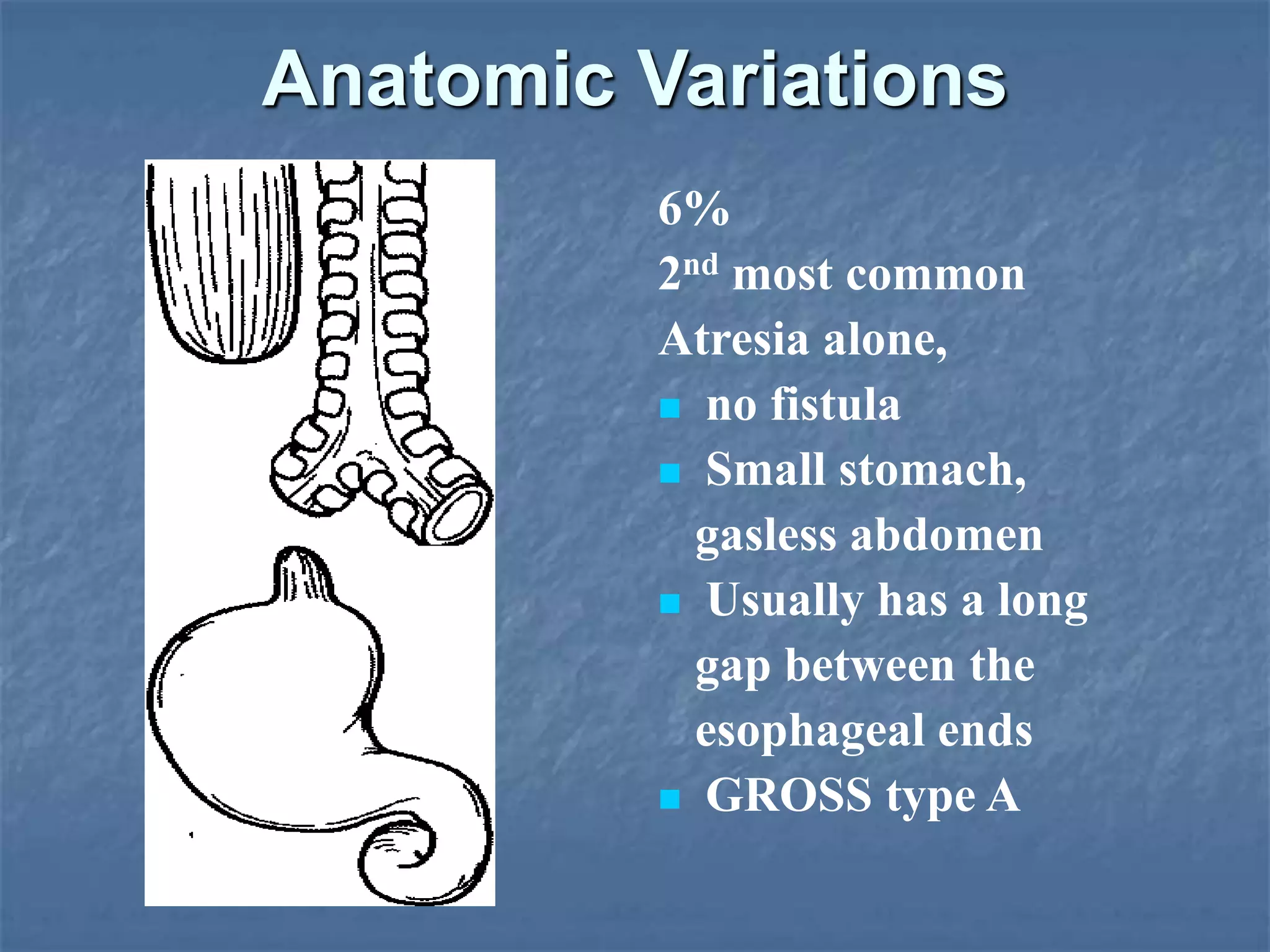 Tracheo oesophageal fistula atresia Everything | PPTX