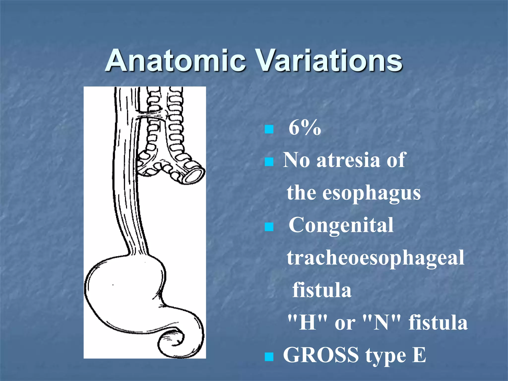 Tracheo oesophageal fistula atresia Everything | PPTX
