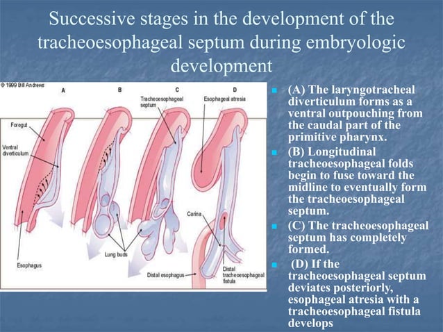 Tracheo oesophageal fistula atresia Everything | PPT