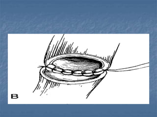 Tracheo oesophageal fistula atresia Everything | PPTX
