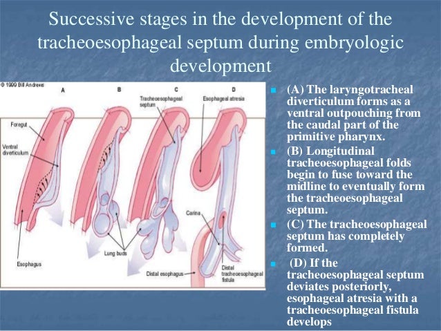 Tracheo oesophageal fistula atresia Everything