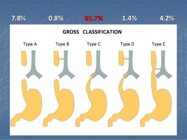 Tracheo oesophageal fistula atresia Everything