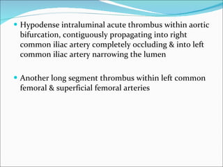 A Case of Aorta-iliac Thromboembolism | PPT