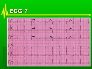 Tehnik pemeriksaan ekg | PPT