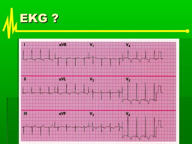 Tehnik pemeriksaan ekg | PPT