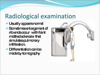 Teitze Syndrome | PPT