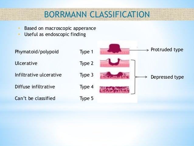 Gastric Cancer / Carcinoma management