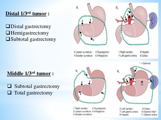 Gastric Cancer / Carcinoma management
