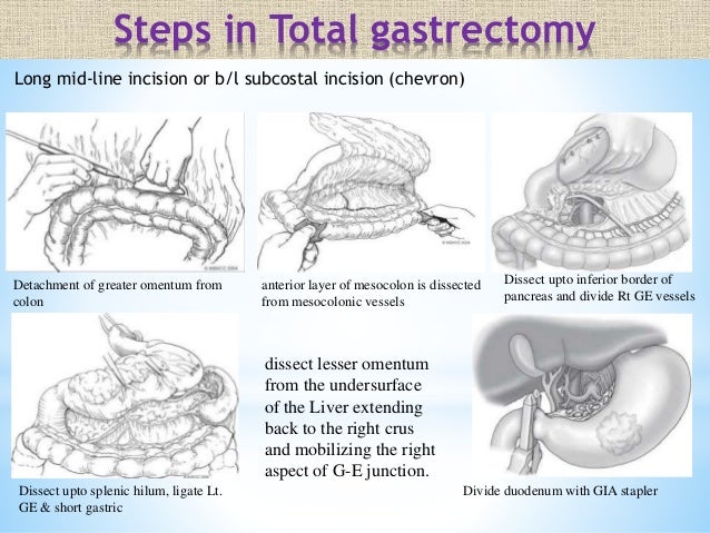 Gastric Cancer / Carcinoma management