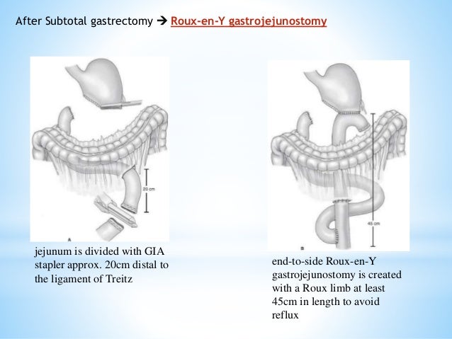 Roux En Y Gastrojejunostomy