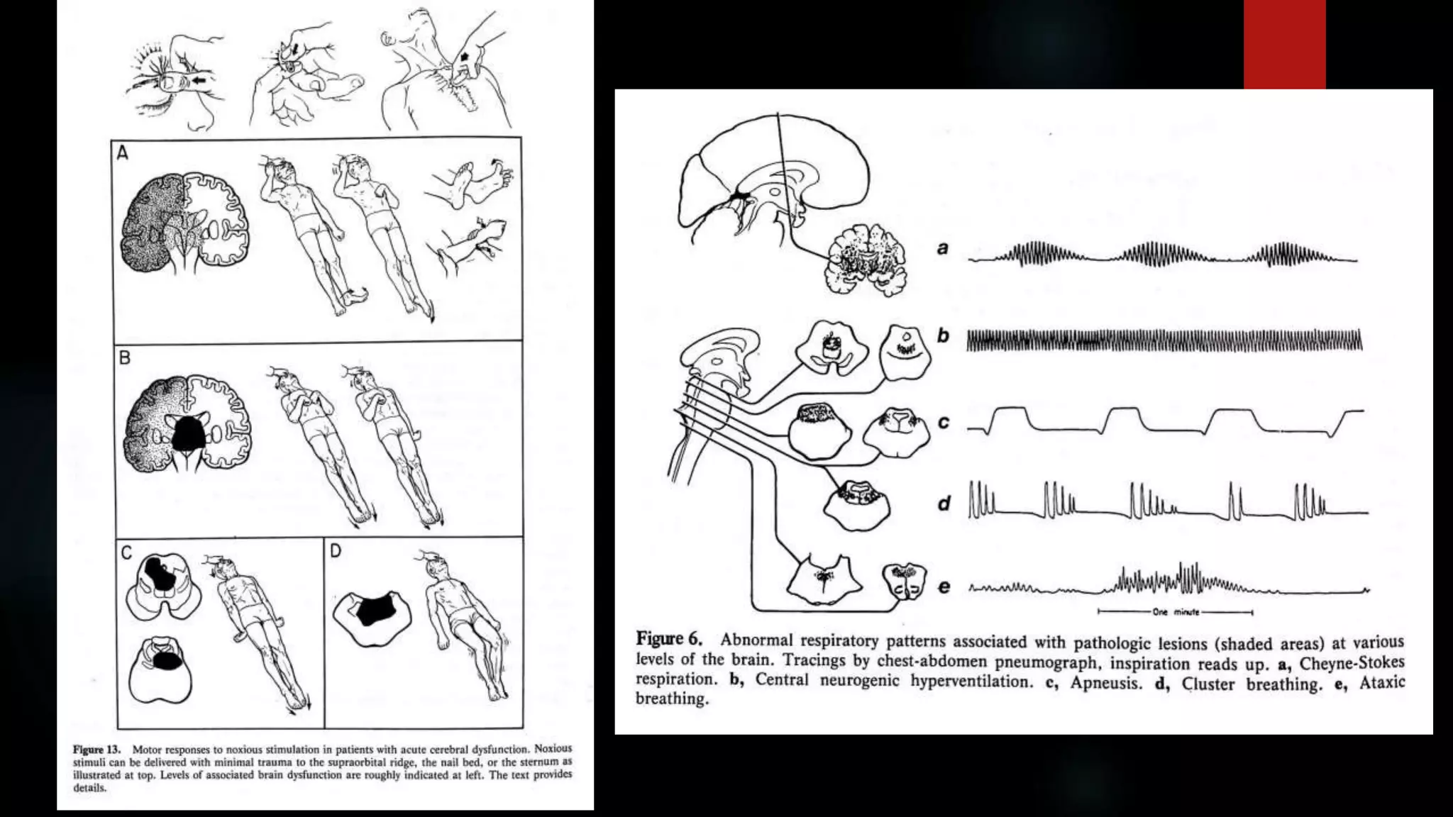 Tekanan Intrakranial | PPTX