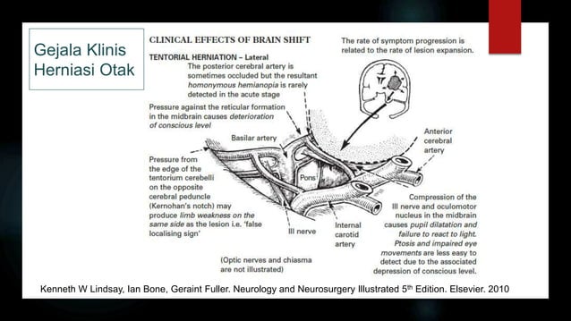 Tekanan Intrakranial | PPTX
