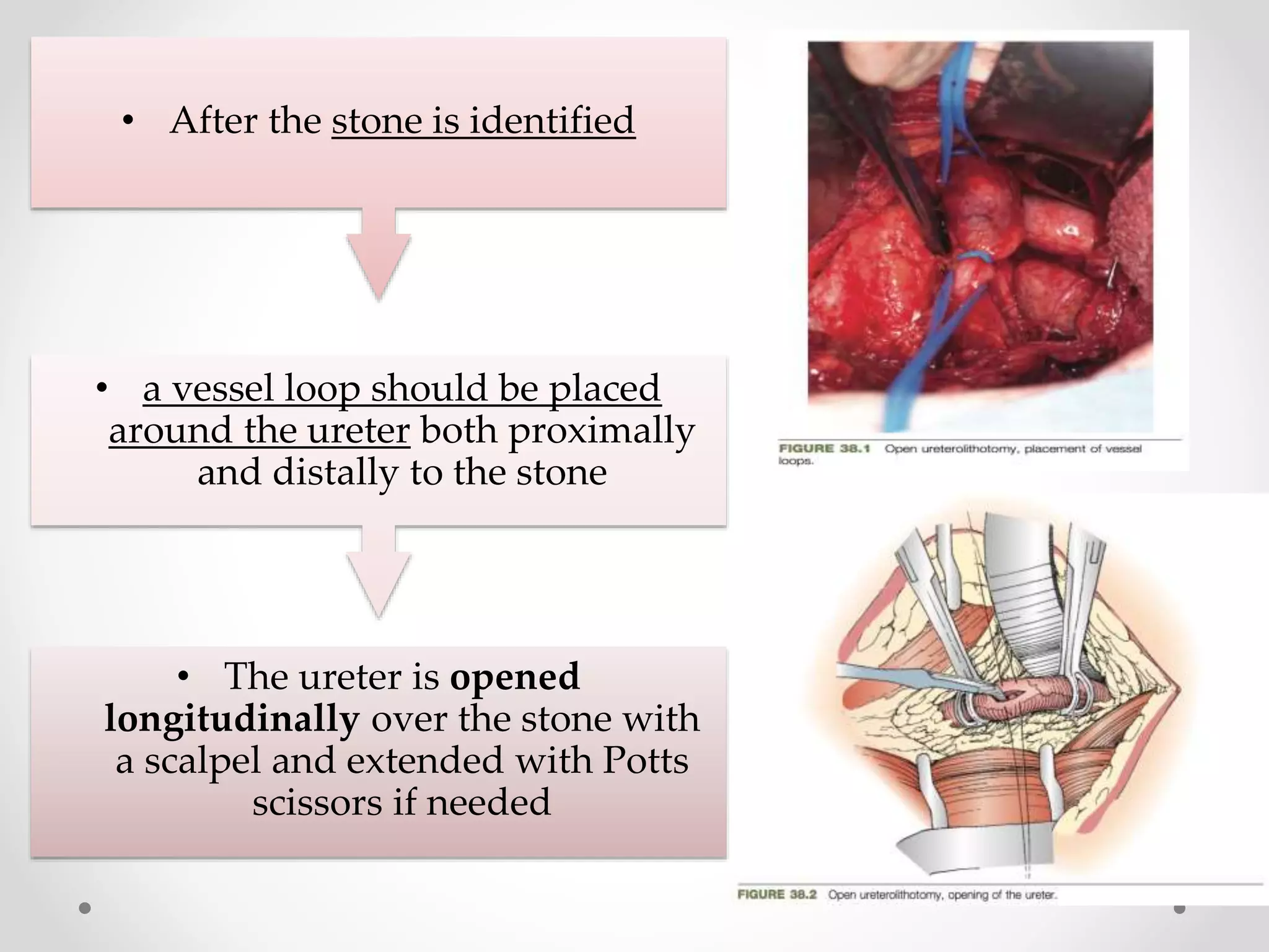 Open Ureterolithotomy | PPTX