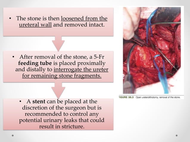 Open Ureterolithotomy | PPTX