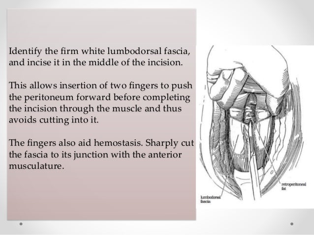 Open Ureterolithotomy