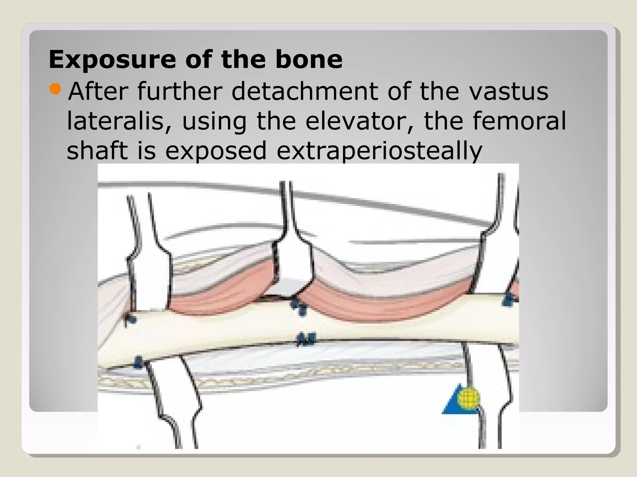 Teknik operasi orif femur | PPT