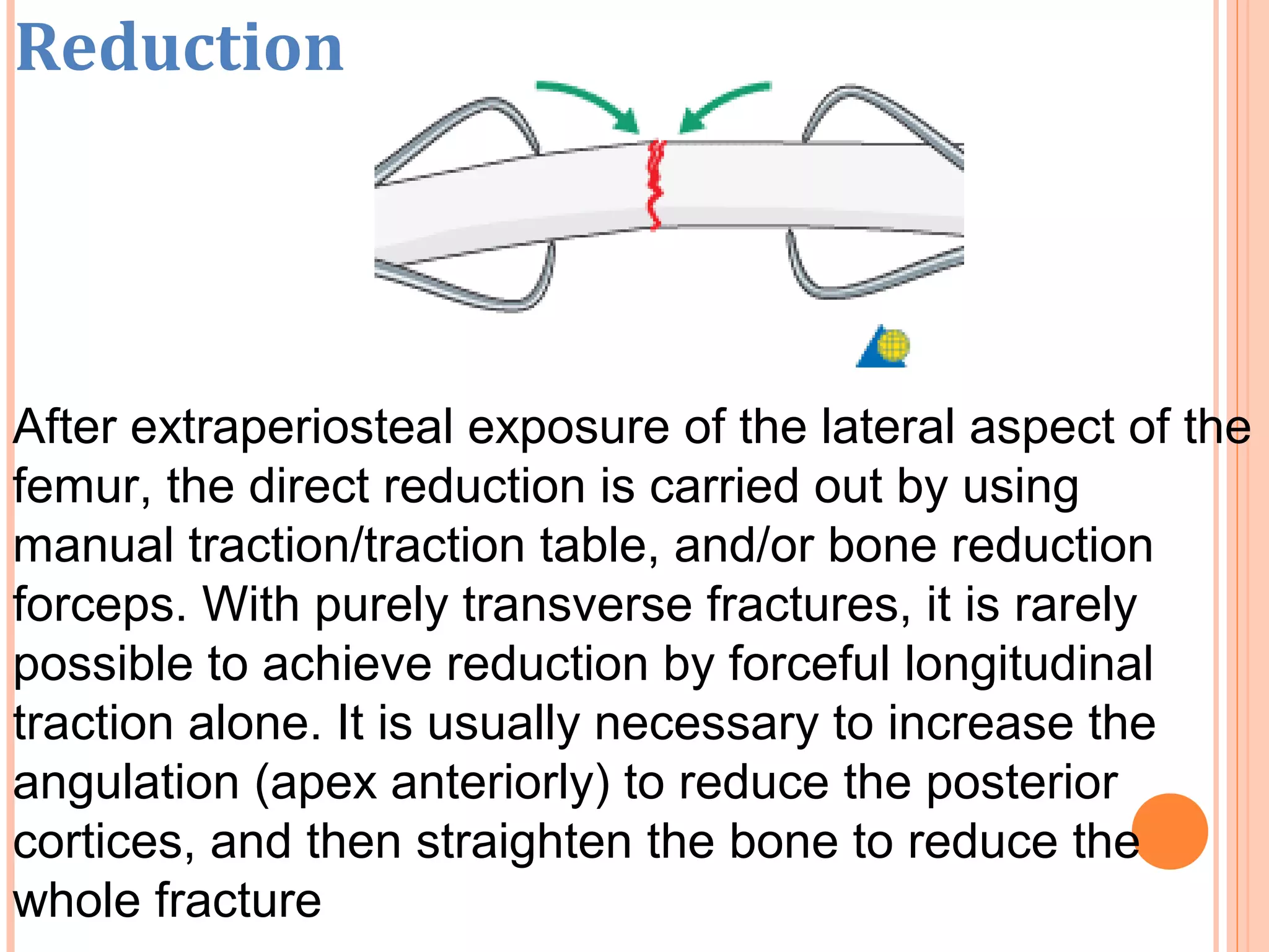 Teknik operasi orif femur | PPT
