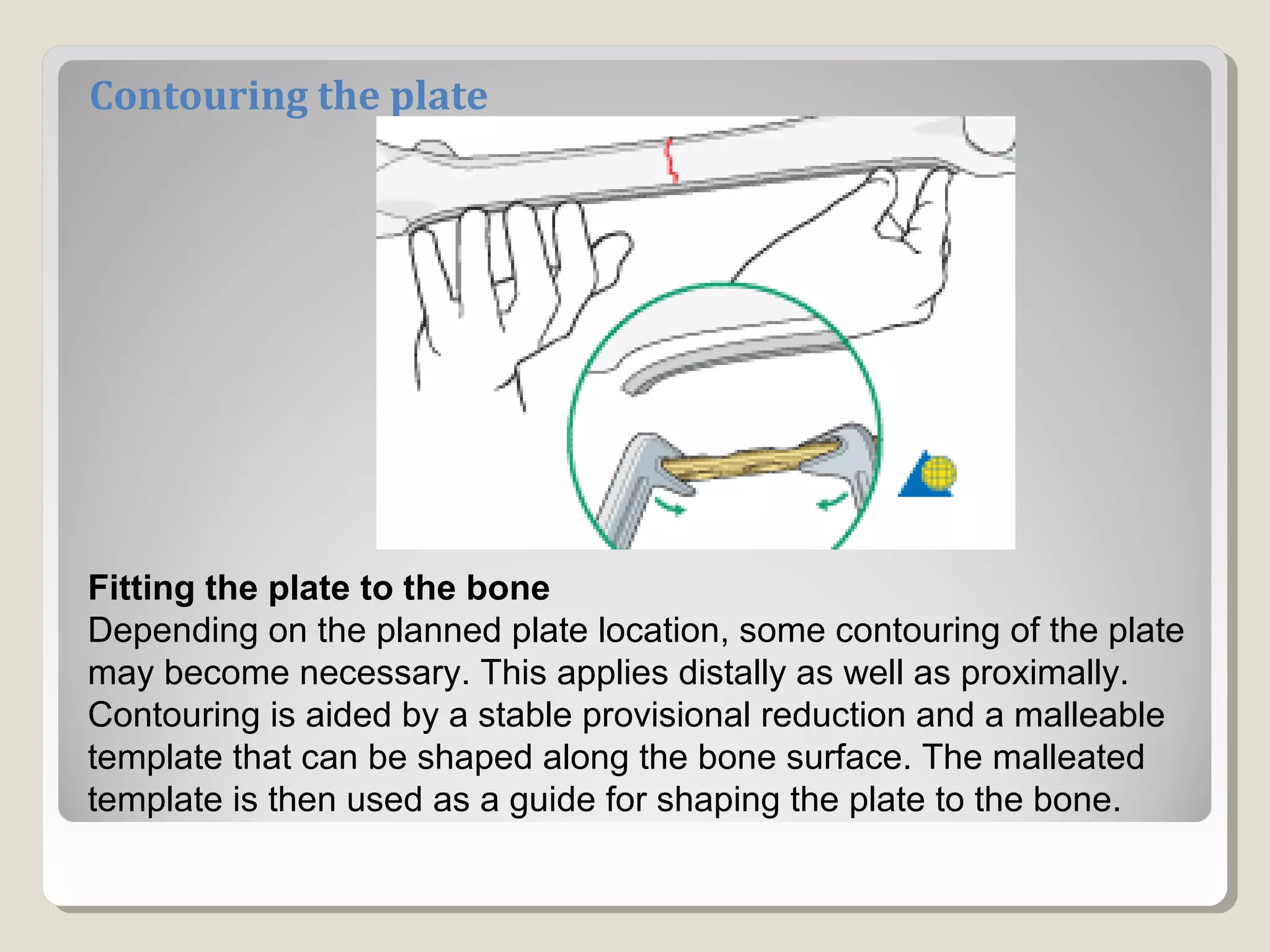 Teknik operasi orif femur | PPT