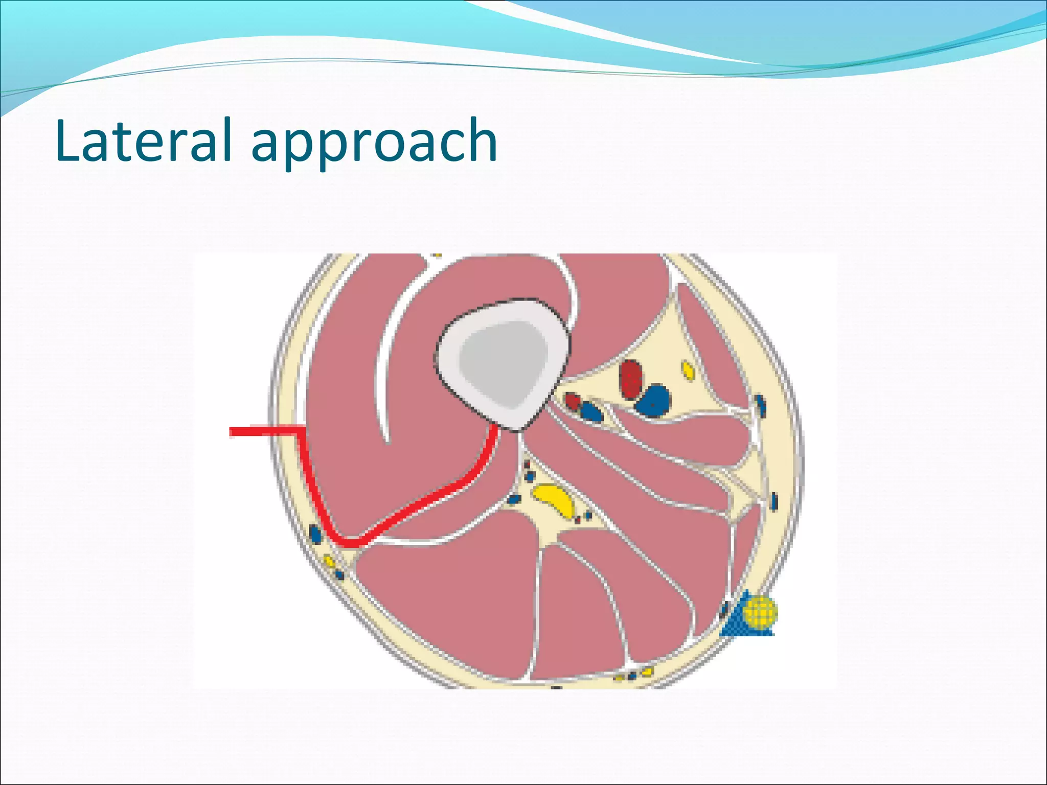 Teknik operasi orif femur | PPT