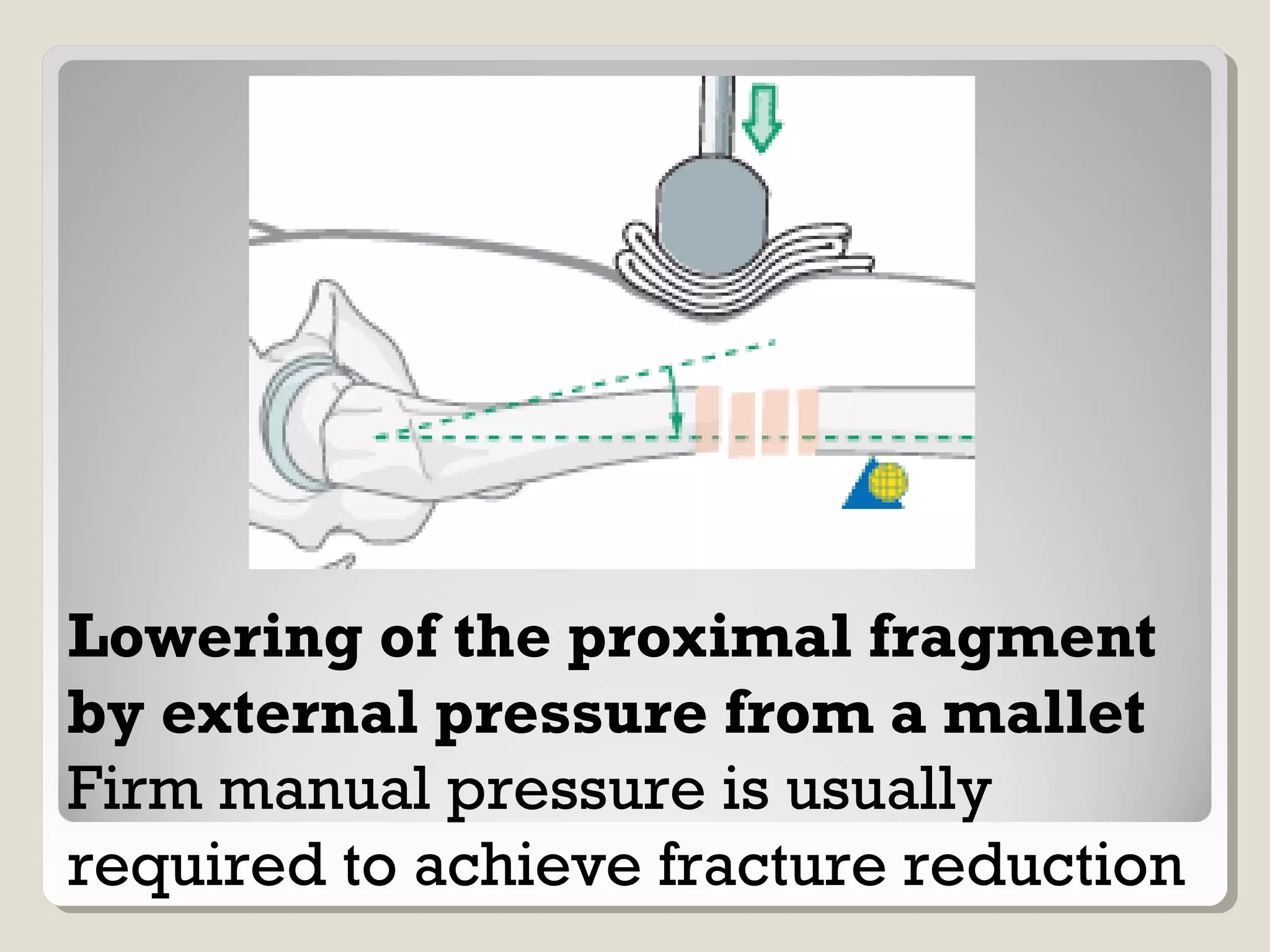 Teknik operasi orif femur | PPT
