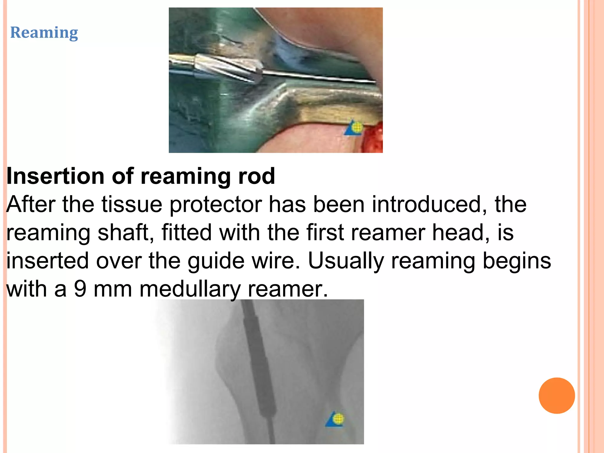 Teknik operasi orif femur | PPT