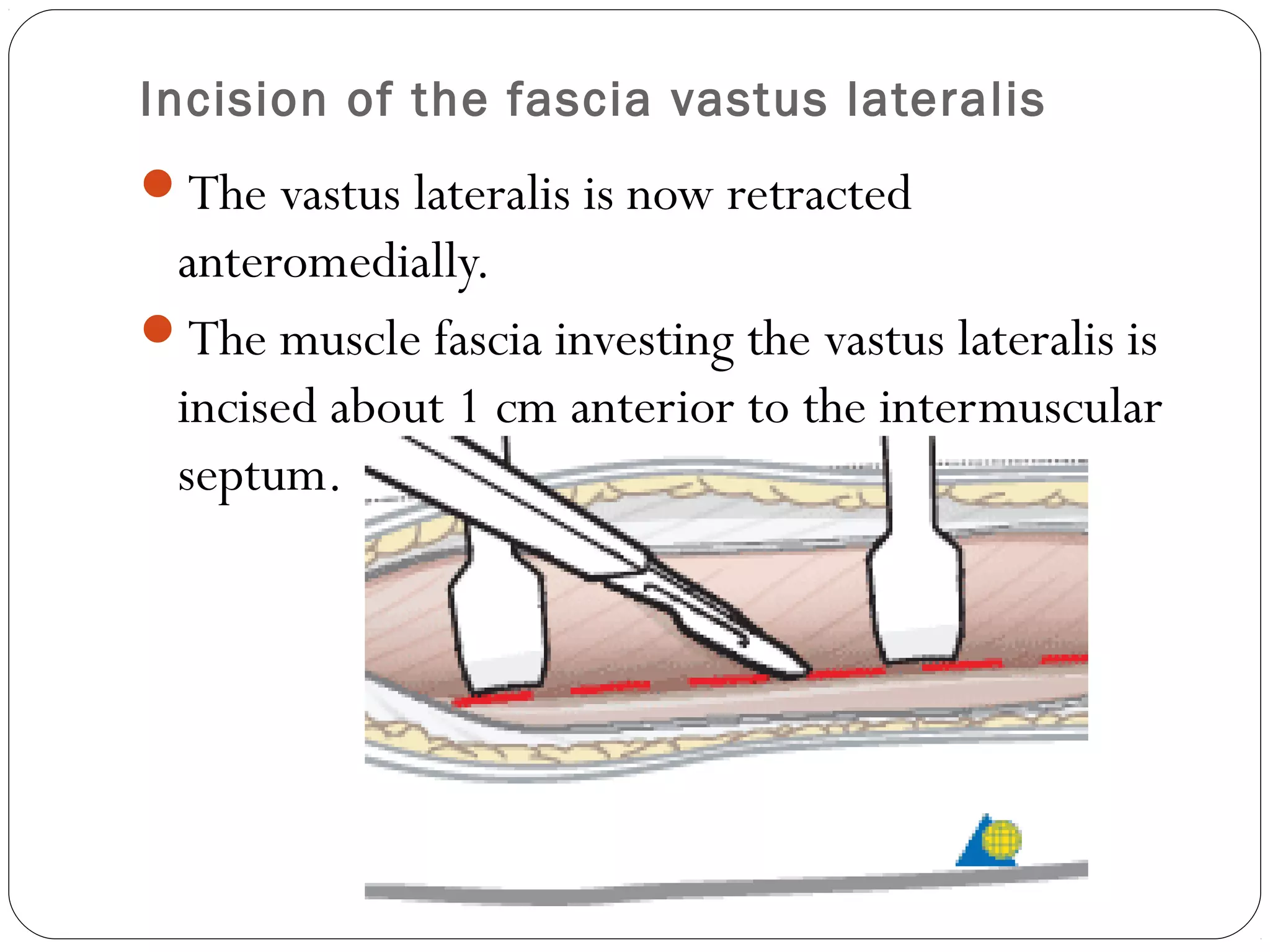 Teknik operasi orif femur | PPT