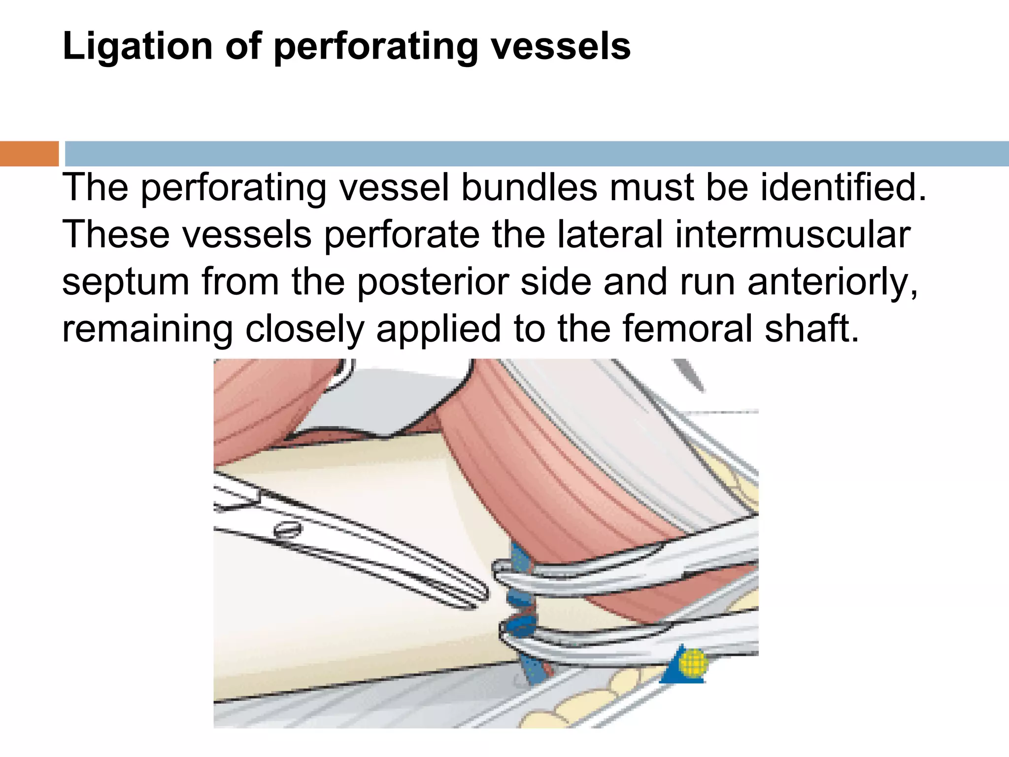 Teknik operasi orif femur | PPT