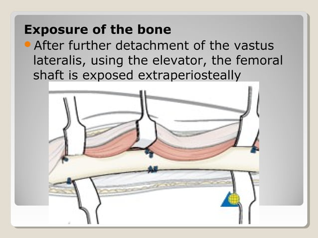 Teknik operasi orif femur | PPT