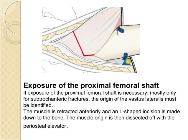 Teknik operasi orif femur | PPT