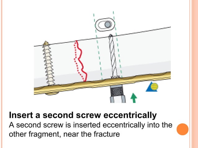 Teknik operasi orif femur | PPT