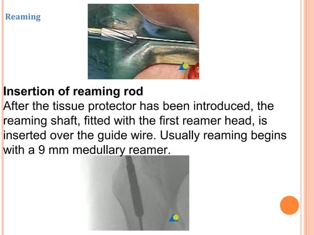 Teknik operasi orif femur | PPT