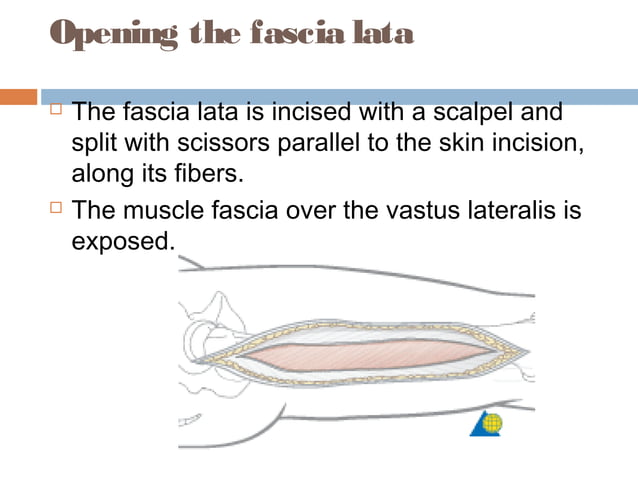Teknik operasi orif femur | PPT