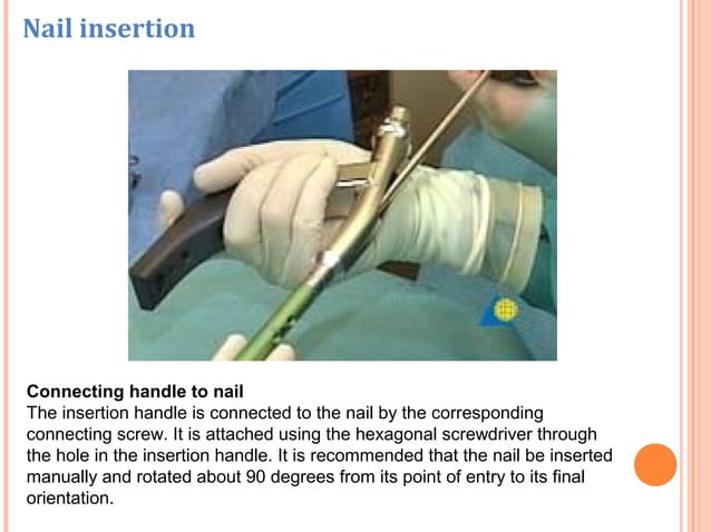 Teknik operasi orif femur | PPT