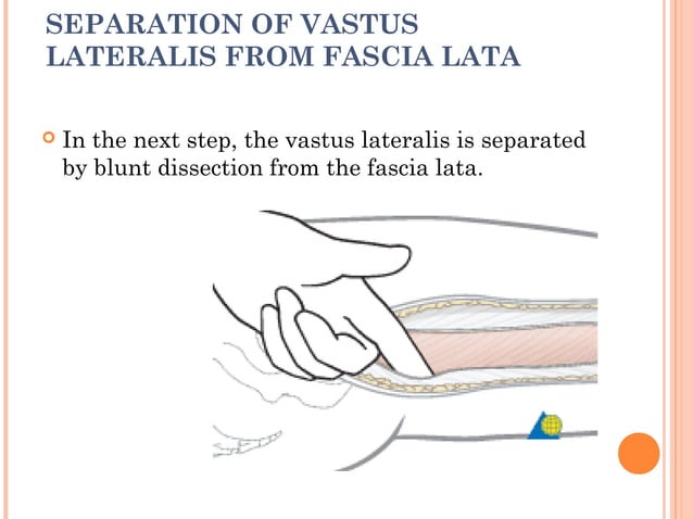 Teknik operasi orif femur | PPT