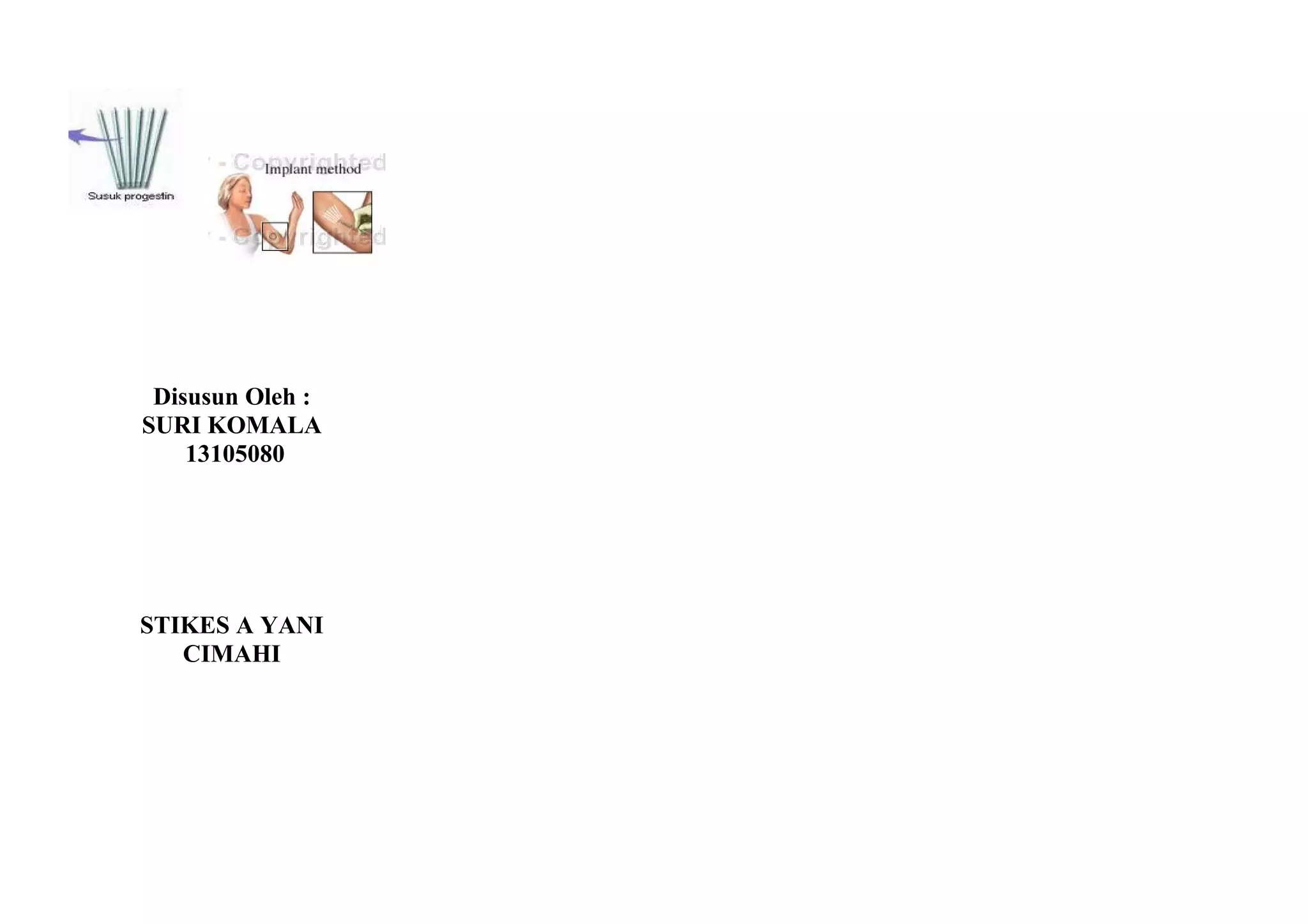Teknik pencabutan implan | DOC