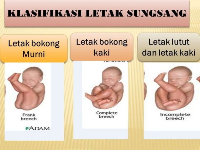 TEKNIK_PERTOLONGAN_PERSALINAN_SUNGSANG_S (1).pptx