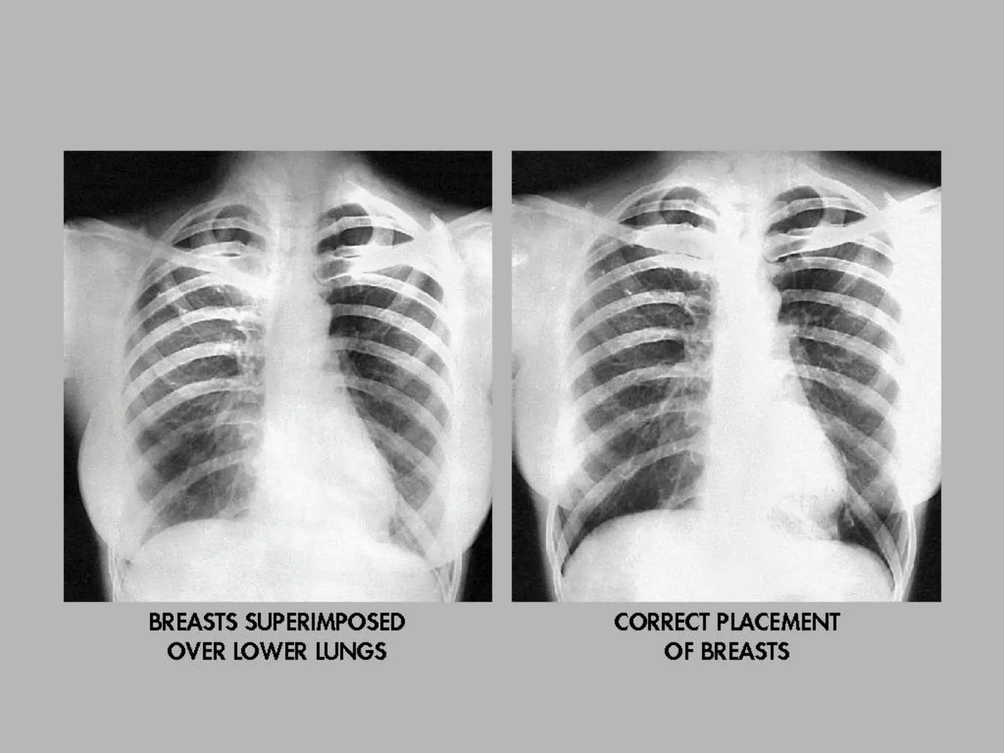 Teknik radiografi (chest xray) | PPTX