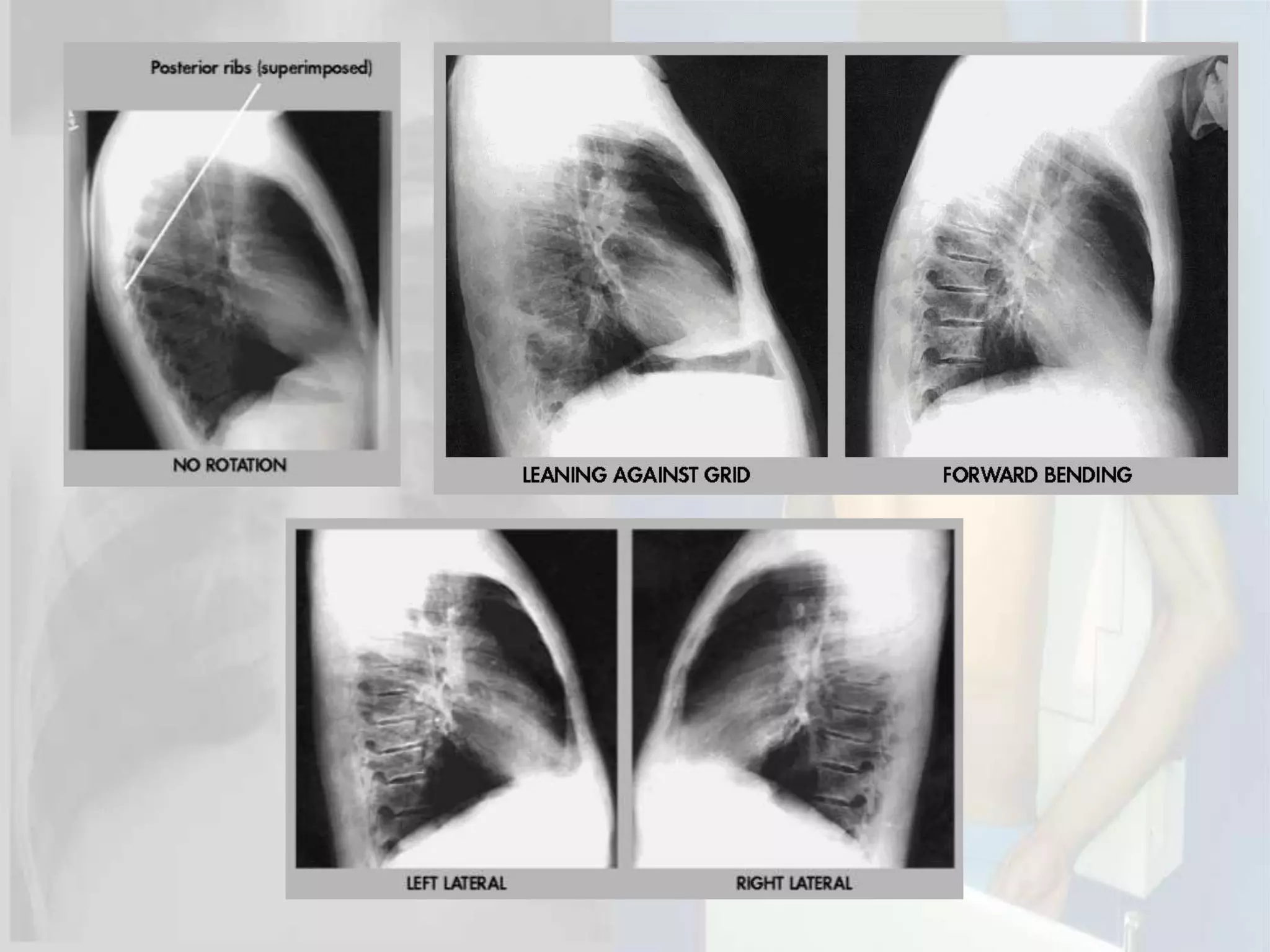 Teknik radiografi (chest xray) | PPTX