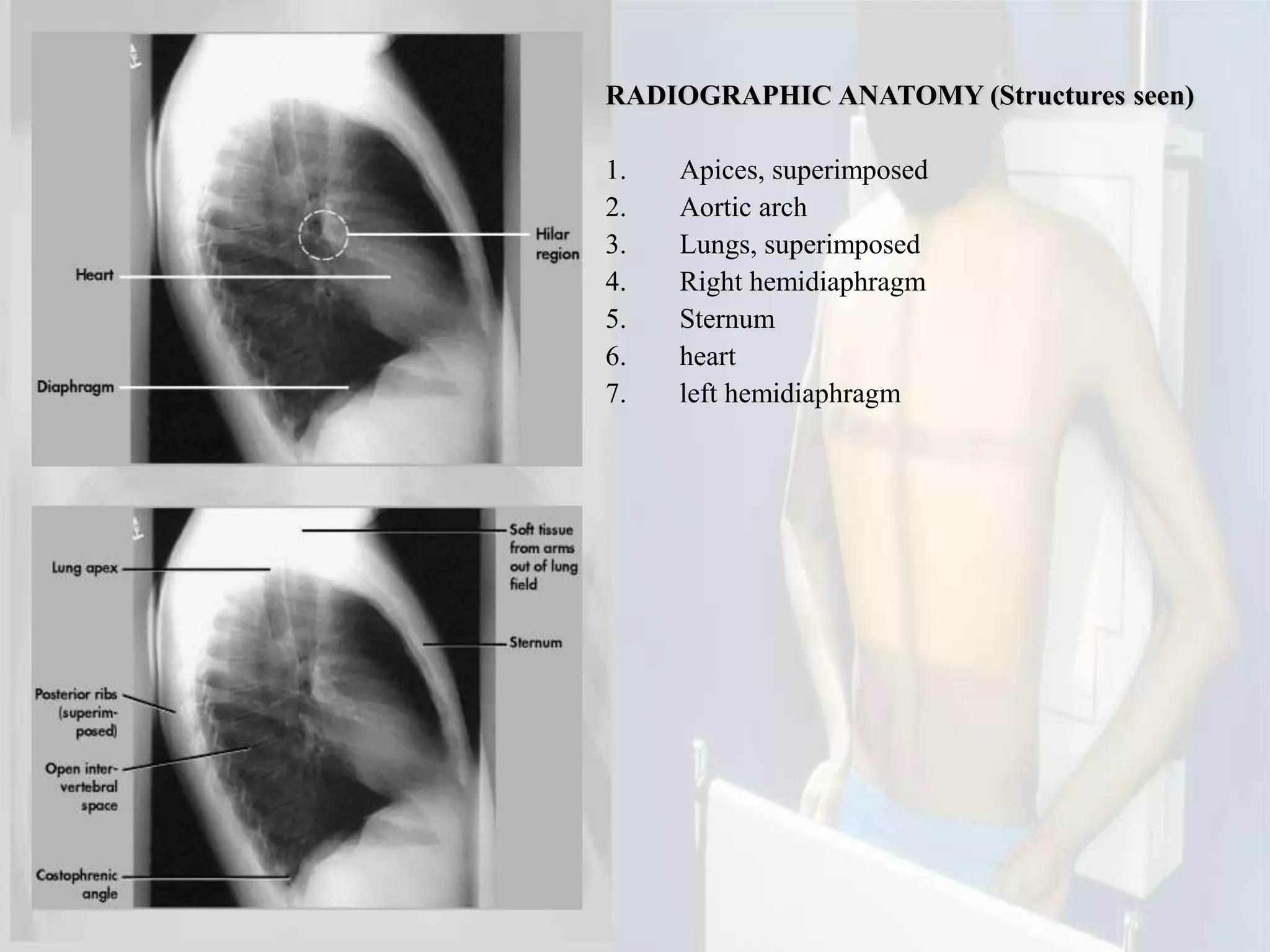 Teknik radiografi (chest xray) | PPTX