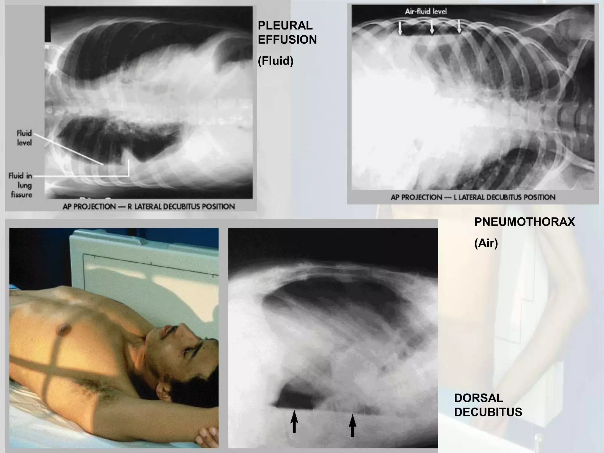 Teknik radiografi (chest xray) | PPTX