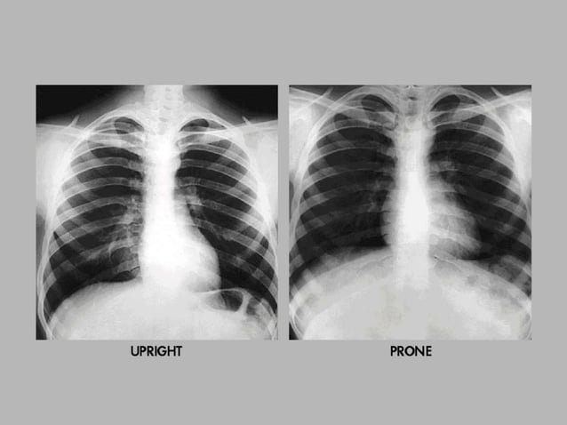 Teknik radiografi (chest xray) | PPTX