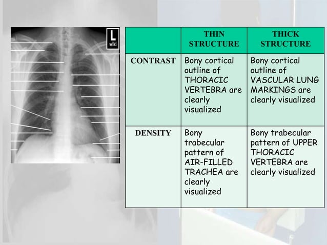 Teknik radiografi (chest xray) | PPTX