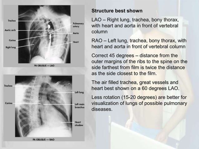 Teknik radiografi (chest xray) | PPTX