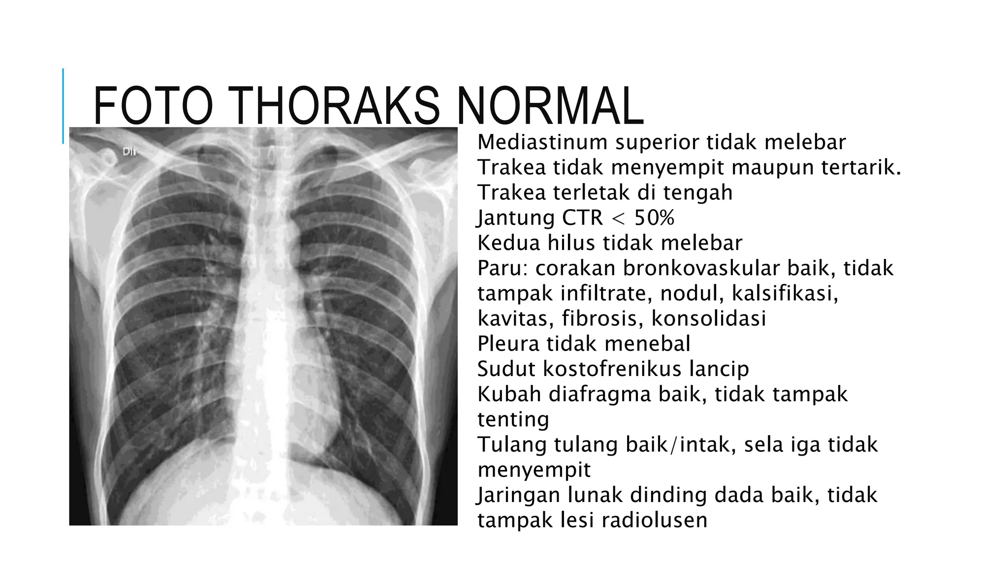 Teknik Radiografi Thoraks.pptx